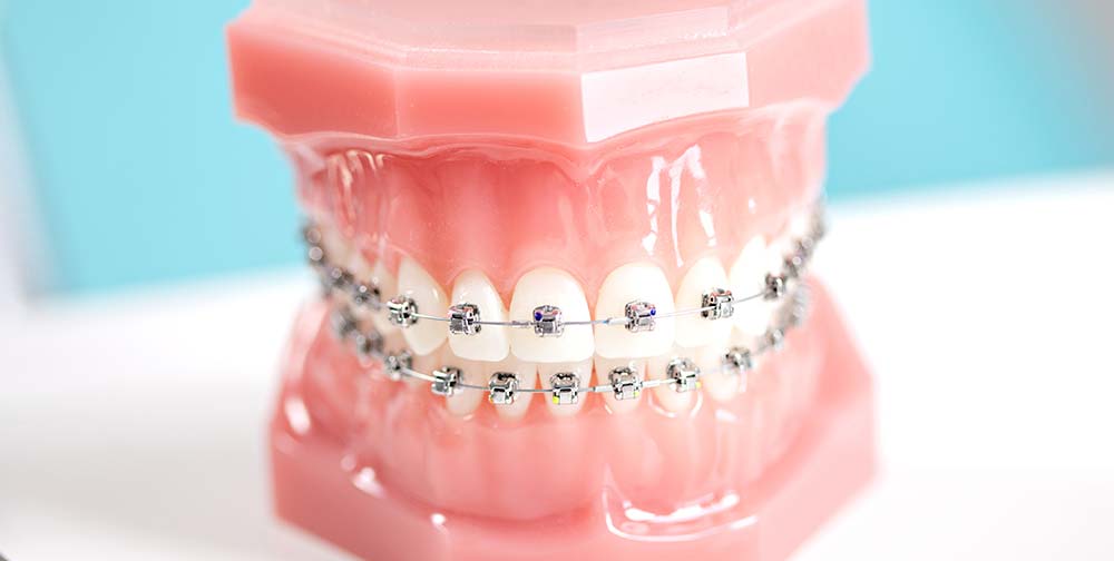 BRACKETS METÁLICOS | Estoclinic - Clínica dental Terrassa