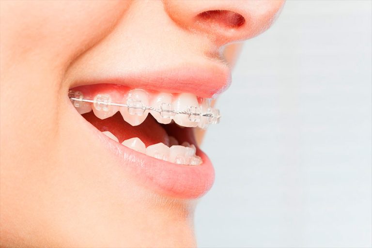 BRACKETS ESTÉTICOS | Estoclinic - Clínica Dental Terrassa