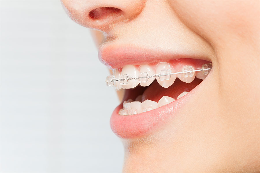 BRACKETS ESTÉTICOS | Estoclinic - Clínica Dental Terrassa